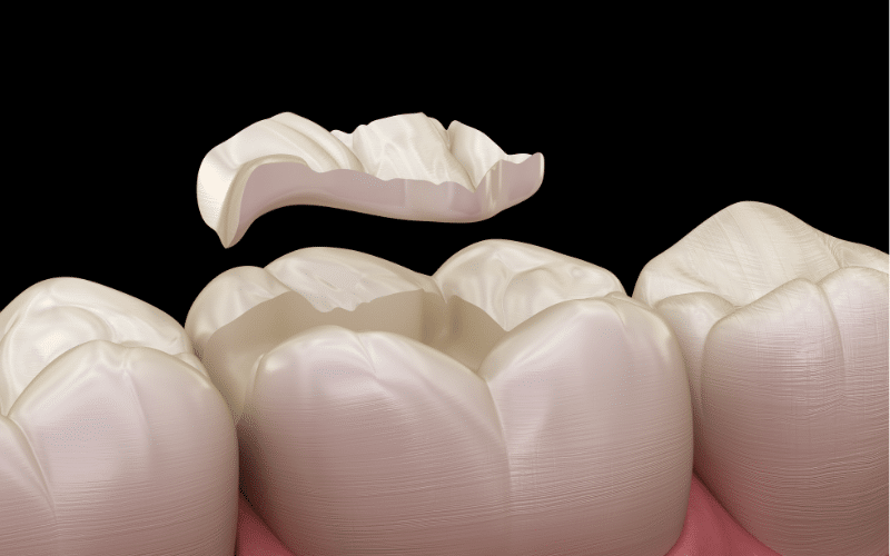 Temporary Dental Filling: A Complete Guide to At-Home Kits & Care