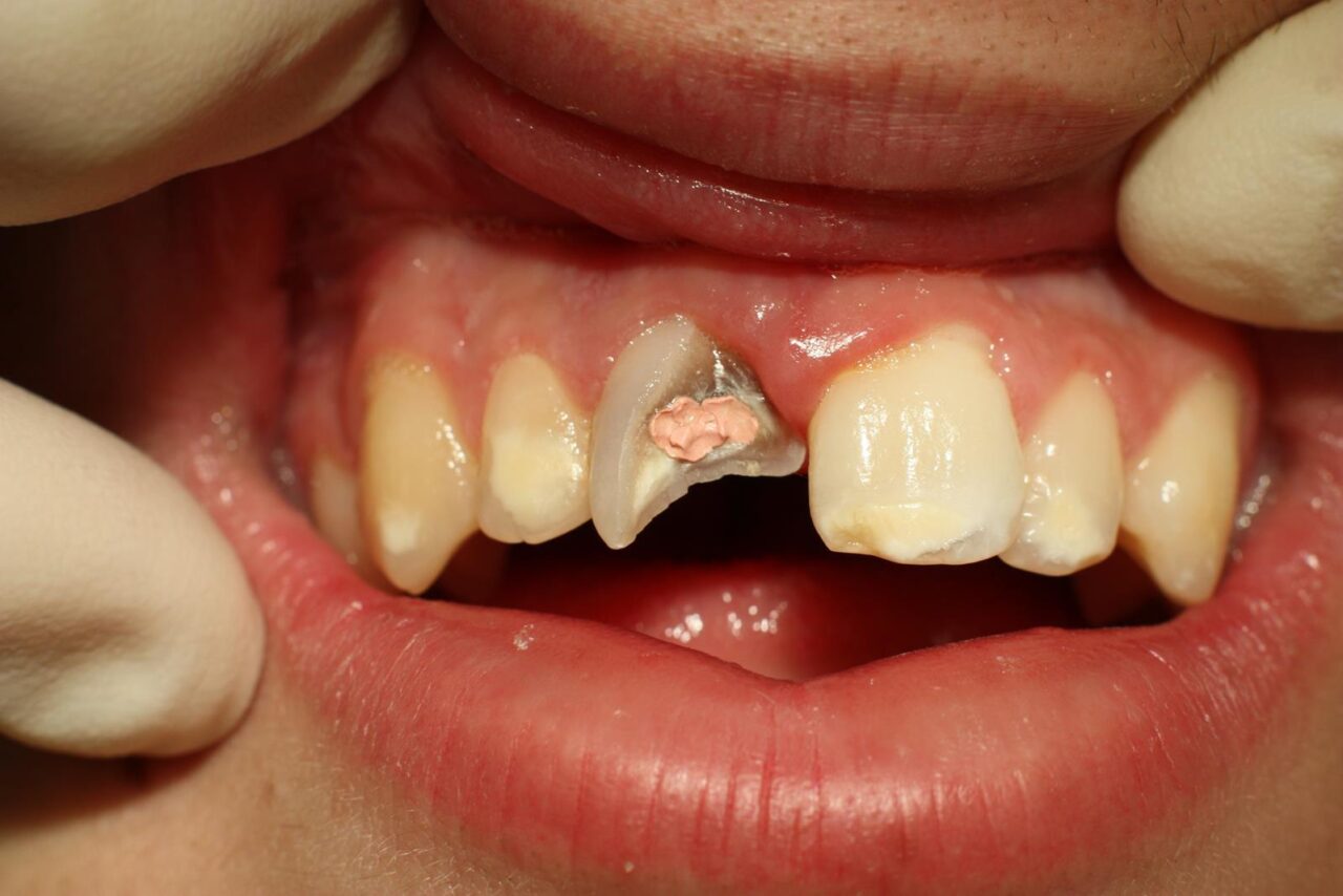 Broken Tooth Pain: What to Do Now & How to Fix It